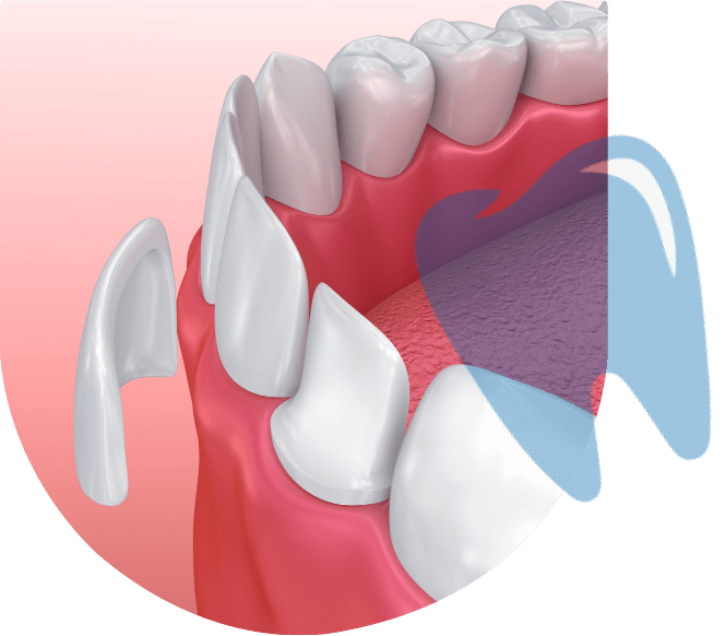 Dental Caps and Veneers | Comfort Dental Clinic